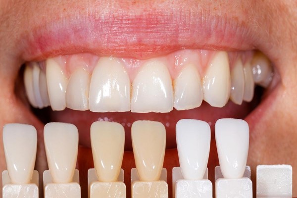 tooth colours – Nova Dental Care